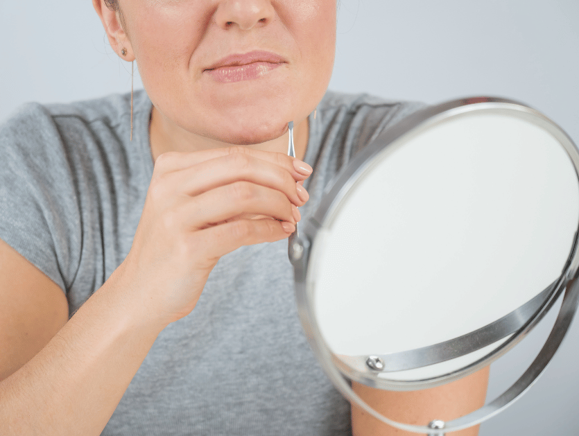 Hirsutism– Excess Facial Hair In Women – Sri Nagesh Clinic